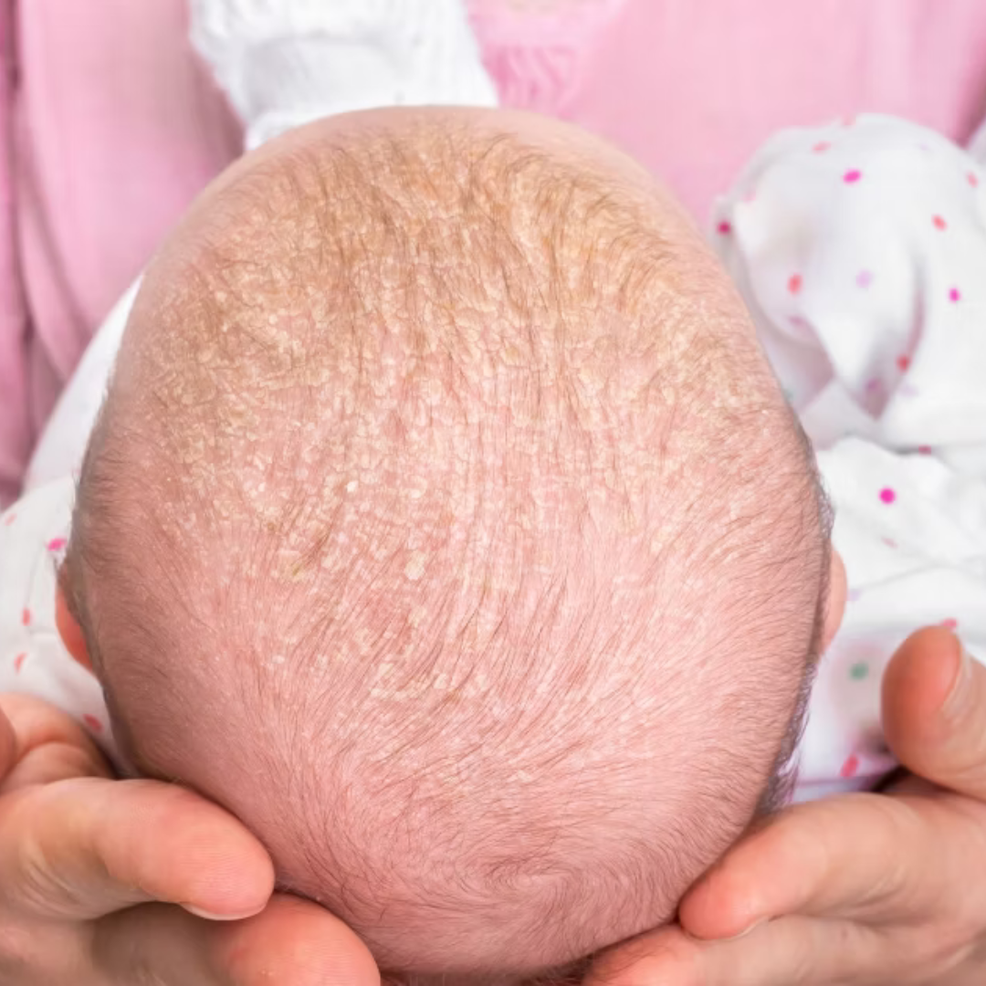 Understanding and Managing Newborn Dry Scalp – SecretsOfTea